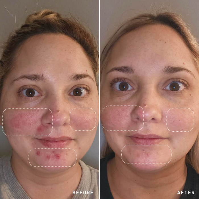 Skin Refine
